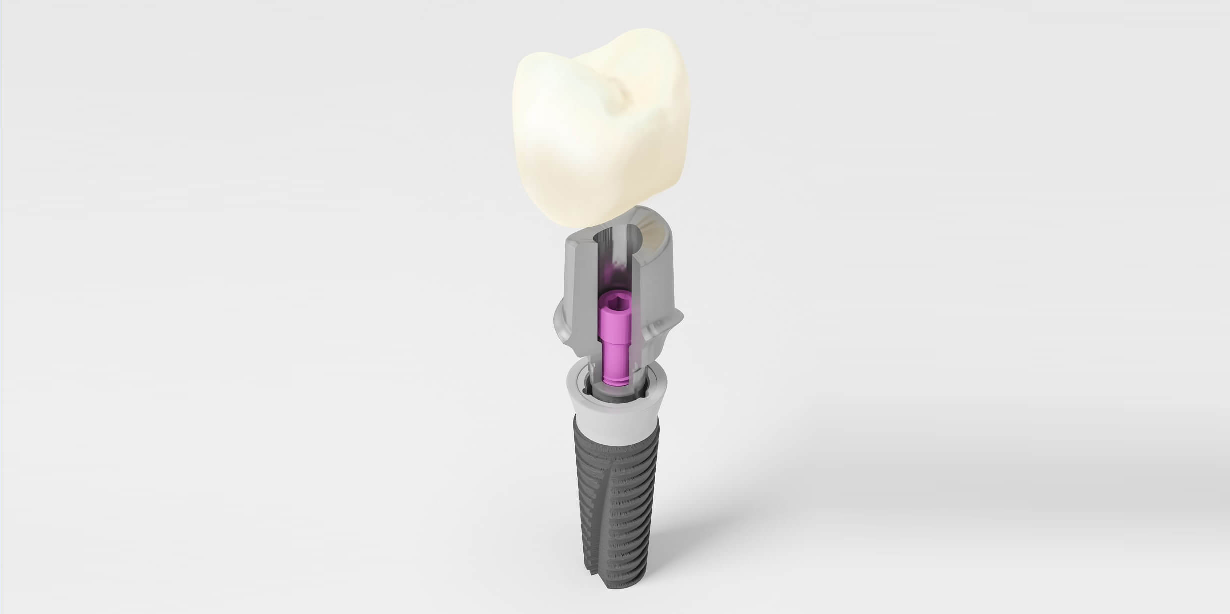 Zahnimplantate Augsburg - Spezialist Dr. Johannes Scherer & Dr. Lisa ...